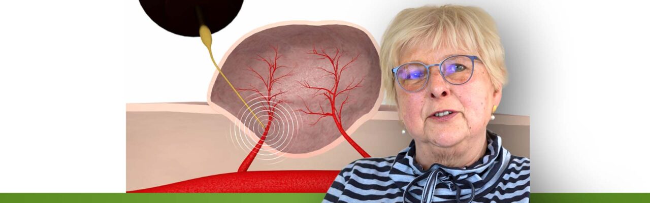 Abszess im Intimbereich behandelt durch sanfte Verödung - Patientenfall ...